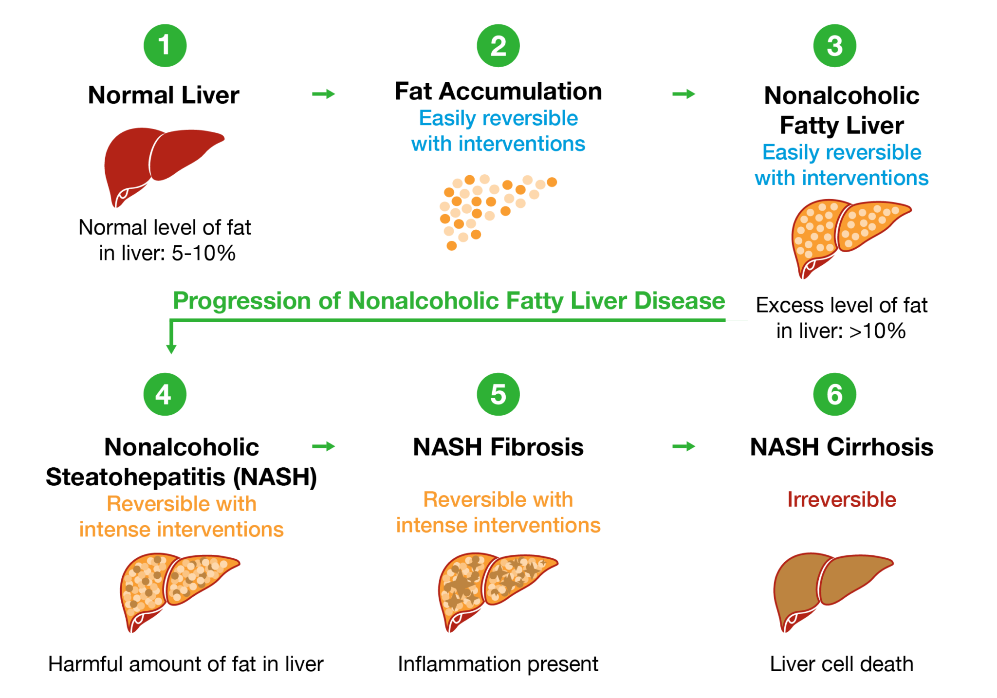 Here’s How Nonalcoholic Fatty Liver Disease Can Lead to Liver Failure ...